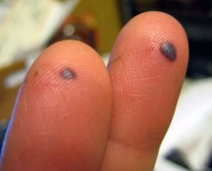 5 Things you may not have known about blood blisters - Health Benefits