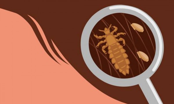 Some Myths and Facts of Lice Disease