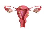 Subserosal Fibroids Explained: Causes, Symptoms, and Solutions - Health ...