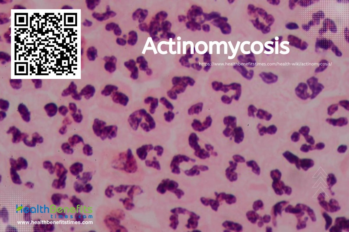 What is Actinomycosis? - Health Benefits