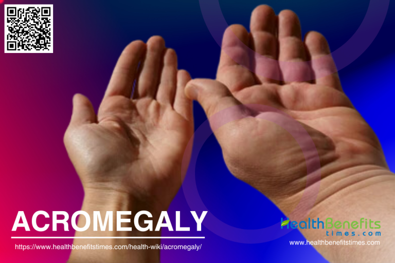 What is Acromegaly? - Health Benefits