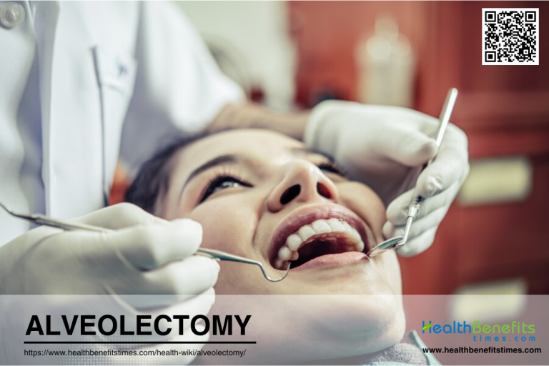 What is Alveolectomy? An overview - Health Benefits