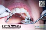 What is Dental amalgam? - Health Benefits