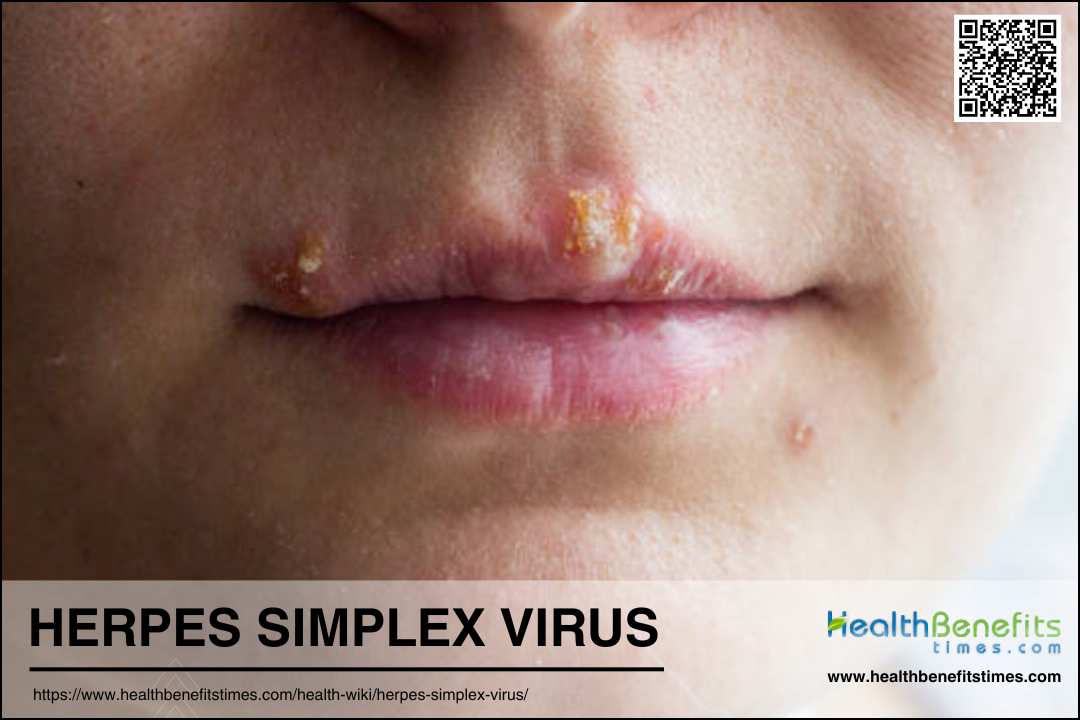 What Is Herpes Simplex Virus Health Benefits
