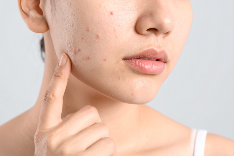 Understanding Why Acne Scars Heal Unevenly Across the Face - Health ...
