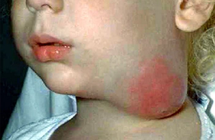 Adenitis - Definition of Adenitis