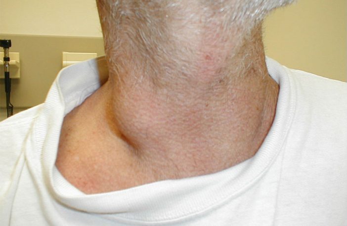 Adenopathy - Definition of Adenopathy