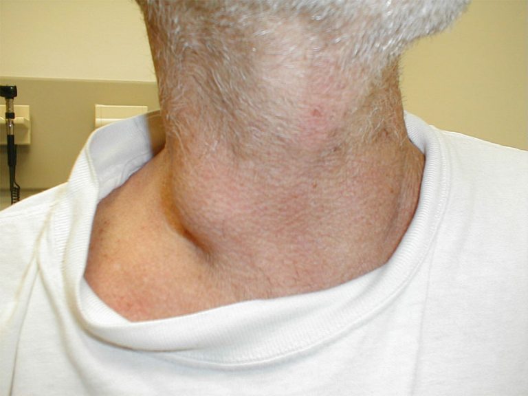 Adenitis Definition Of Adenitis Adenitis Definition Of Adenitis