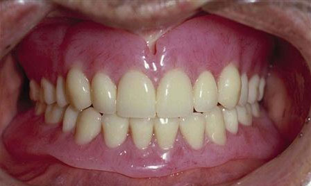 All‐polymer prosthesis - Definition of All‐polymer prosthesis