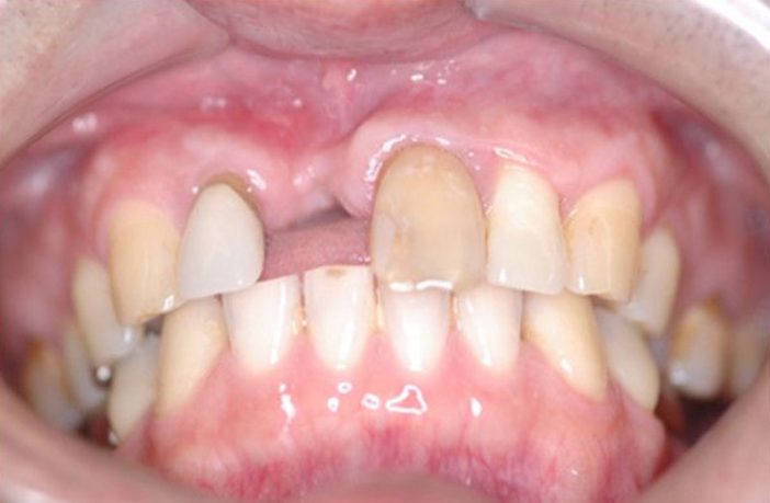 Alveolar - Definition of Alveolar