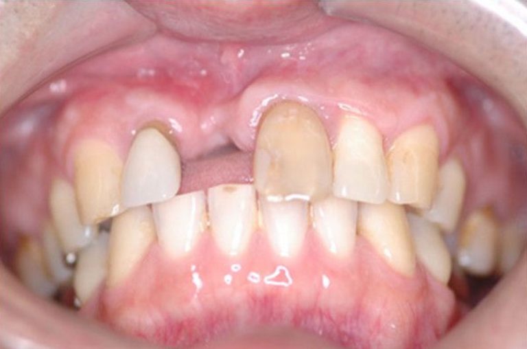 Alveolar atrophy - Definition of Alveolar atrophy