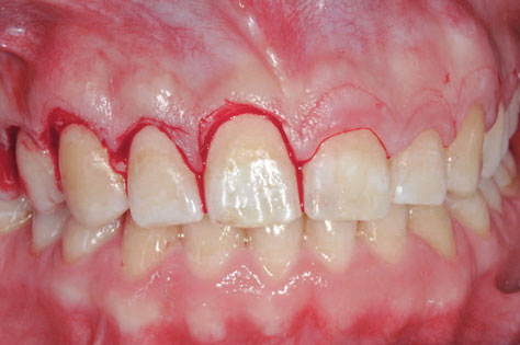 Anatomic crown - Definition of Anatomic crown