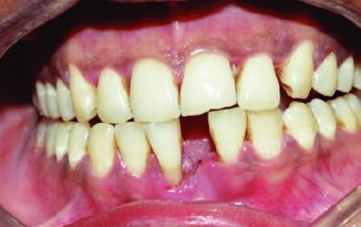 Atraumatic - Definition of Atraumatic