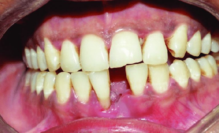 Atraumatic - Definition of Atraumatic