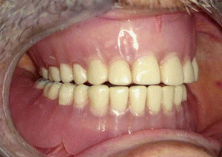 Balanced occlusion - Definition of Balanced occlusion