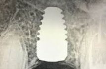 Bicortical stabilization - Definition of Bicortical stabilization