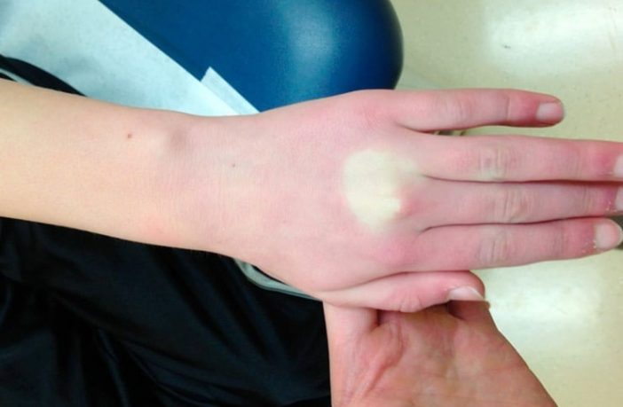 Blade implant - Definition of Blade implant