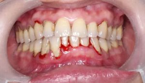 Bleeding - Definition of Bleeding