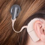 Bone‐anchored hearing aid (BAHA) - Definition of Bone‐anchored hearing ...