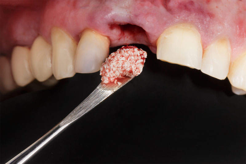 Bone grafting - Definition of Bone grafting