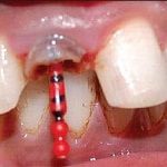 Cast post‐and‐core - Definition of Cast post‐and‐core