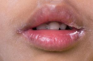 Cheilosis - Definition of Cheilosis