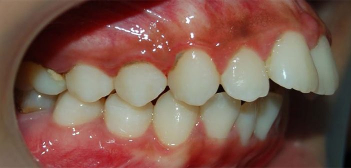 Class II malocclusion (distoocclusion) - Definition of Class II ...