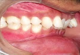 Class II, Division 1 malocclusion - Definition of Class II, Division 1 ...