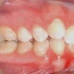 Class II malocclusion (distoocclusion) - Definition of Class II ...