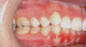 Class I malocclusion (neutroocclusion) - Definition of Class I ...