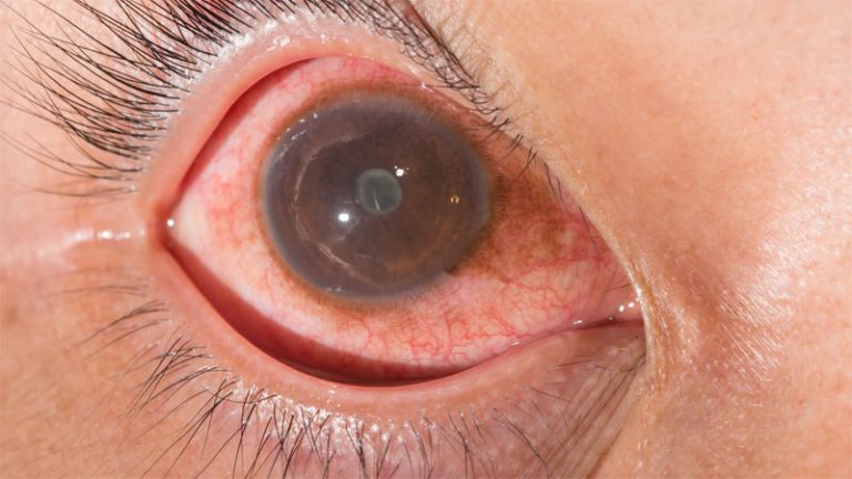 Anterior uveitis - Definition of Anterior uveitis