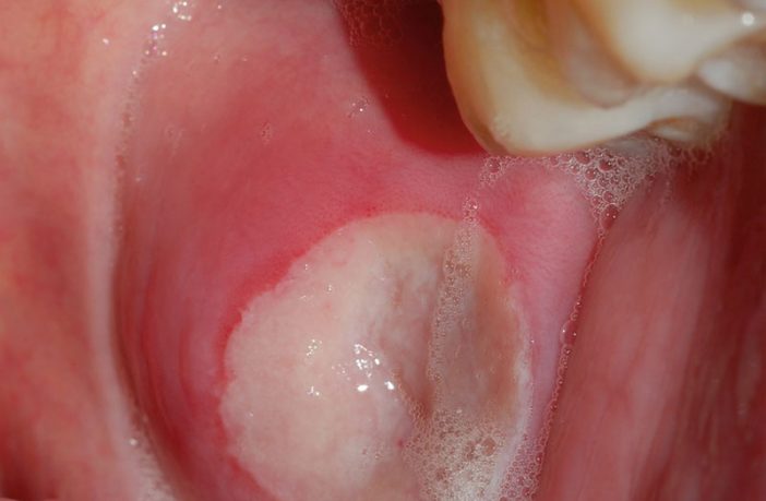 Aphthae - Definition of Aphthae