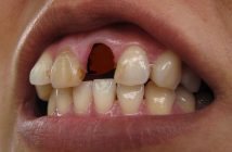 Avulsed teeth - Definition of Avulsed teeth