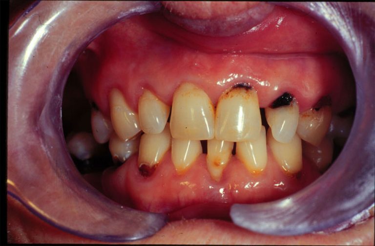 Caries - Definition of Caries