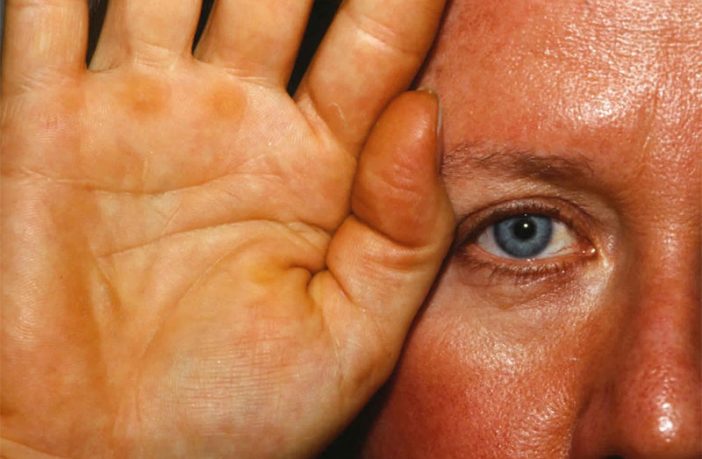 Carotenodermia - Definition of Carotenodermia