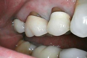 Crown - Definition of Crown