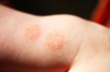 Dermatitis - Definition of Dermatitis