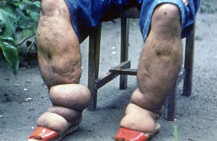 Elephantiasis - Definition of Elephantiasis