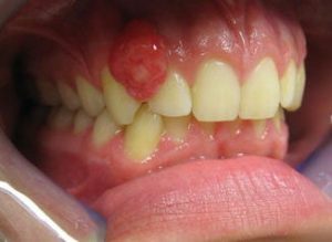 Epulis - Definition of Epulis