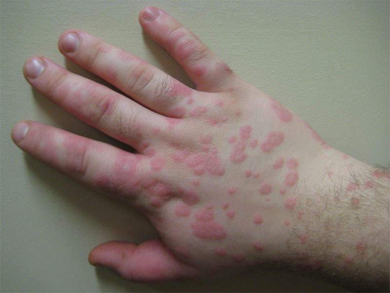 Erythema multiforme - Definition of Erythema multiforme