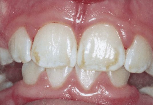Fluorohydroxyapatite (FHA) - Definition of Fluorohydroxyapatite (FHA)