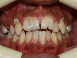 Fused teeth - Definition of Fused teeth