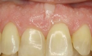 Gingival cleft - Definition of Gingival cleft