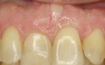 Gingival abscess - Definition of Gingival abscess