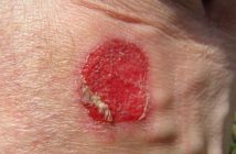 Granulation tissue - Definition of Granulation tissue