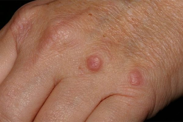 Granuloma - Definition of Granuloma
