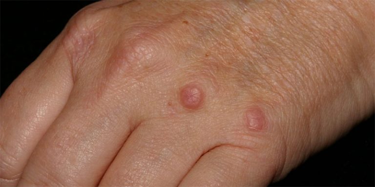 Granulation tissue - Definition of Granulation tissue