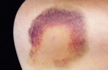 Hematoma - Definition of Hematoma