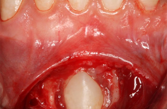 Impaction of tooth - Definition of Impaction of tooth