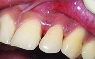 Interdental bone height - Definition of Interdental bone height